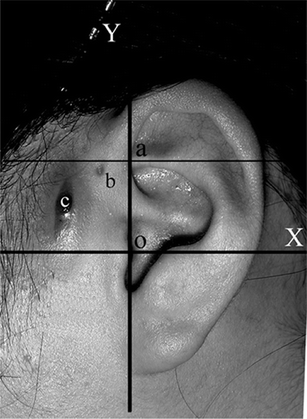 Limited distribution of gravitation abscess caused by infected ...