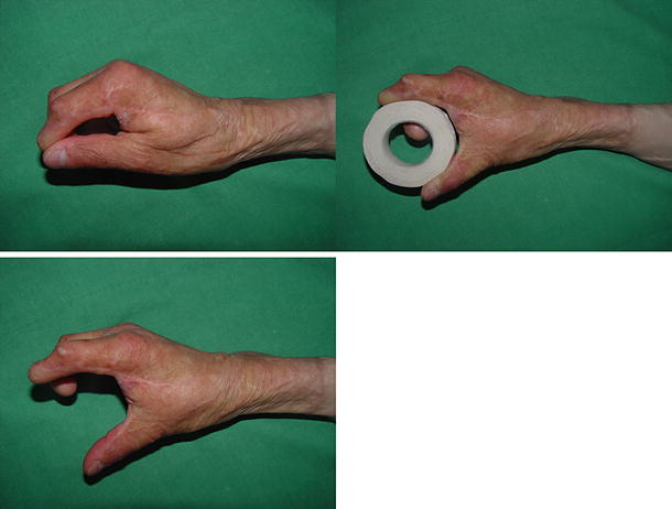 Reconstruction of the first web space in severely burned hand by the ...