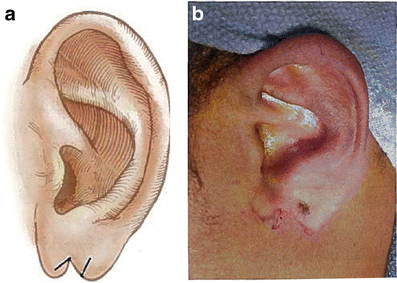 A long-term review of Z-plasty technique for repair of split earlobes ...