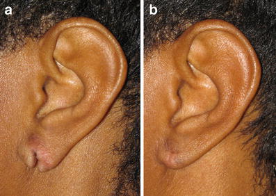 A long-term review of Z-plasty technique for repair of split earlobes ...