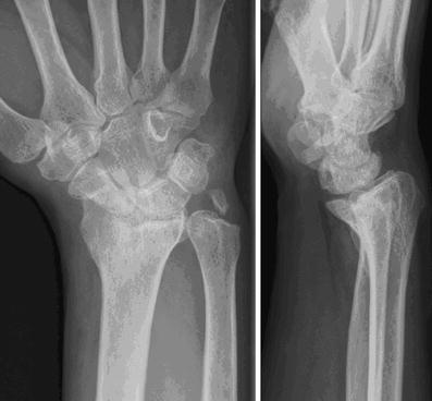 Treatment of post-traumatic degenerative changes of the radio-carpal ...