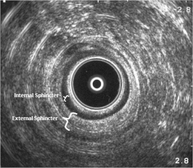 Martius flap: historical and anatomical considerations | SpringerLink