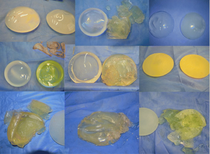 Rupture of Poly Implant Prothèse (PIP) breast implants: experience with ...