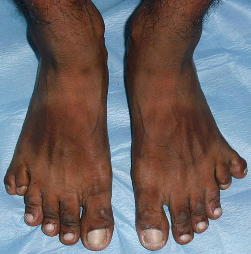 An unusual case of postaxial polydactyly of the feet | SpringerLink