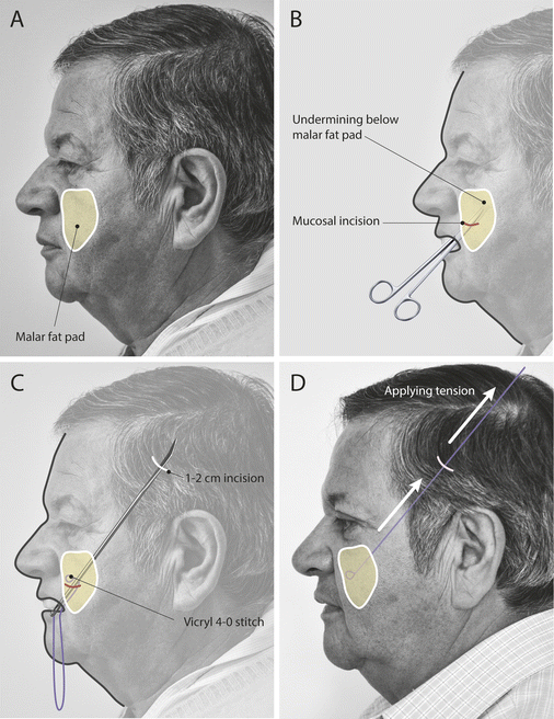 Malar fat pad suspension through intraoral approach: a personal ...