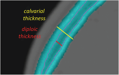 Thickness of calvarium and diploic space in children ages 0 to 17 as ...
