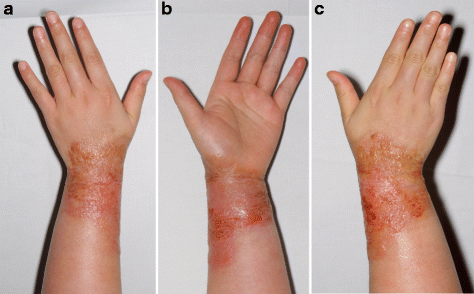 Chemical burns from topical use of traditional Chinese medicine ...