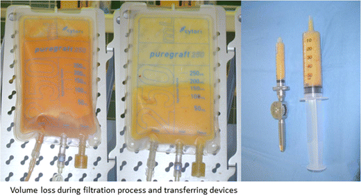 Lipofilling effects after breast cancer surgery in post-radiation ...