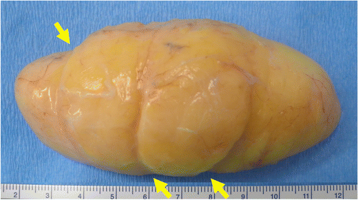 Subcutaneous lipomas: A minimally invasive method for resection of ...