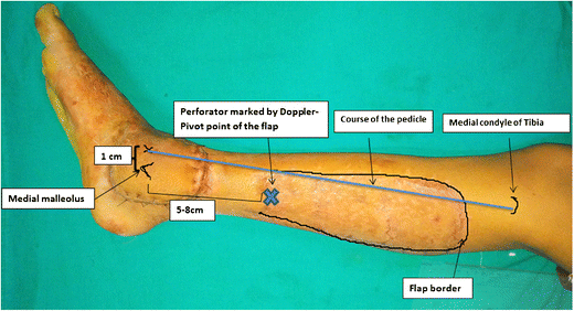 Versatile distally based neurocutaneous saphenous flap in the era of ...