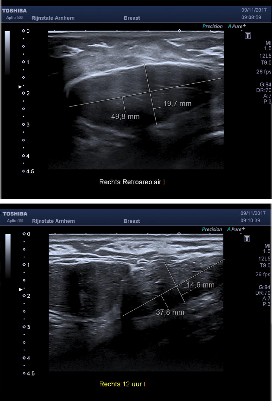 Rapidly-growing pseudoangiomatous stroma hyperplasia (PASH) causing ...