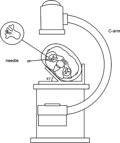 Percutaneous nephrolithotomy in semisupine position: a modified ...