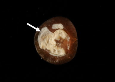 Randall’s plaque as the origin of calcium oxalate kidney stones ...