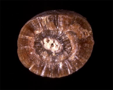 Randall’s plaque as the origin of calcium oxalate kidney stones ...