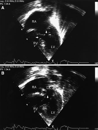 A Criss-Cross Heart with Twisted Atrioventricular Connections, “Perfect ...