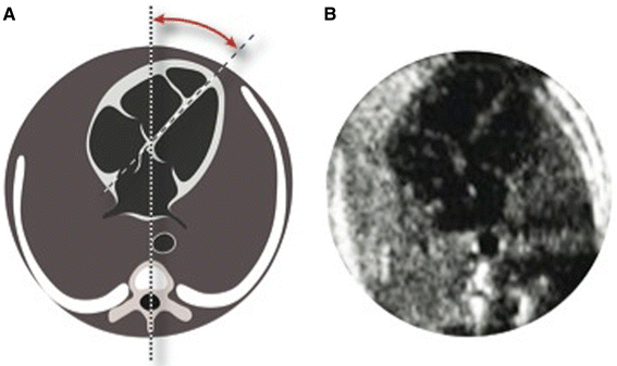 Dextrocardia: Practical Clinical Points and Comments on Terminology ...