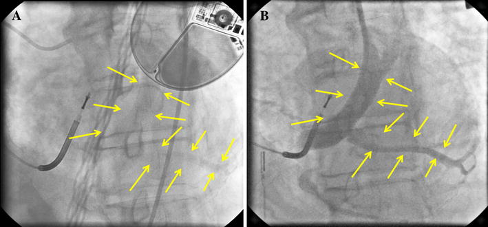 Successful Percutaneous Cardiac Resynchronization Despite an Occlusive ...