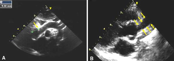 Atypical Shone’s Complex Diagnosed by Echocardiography | SpringerLink