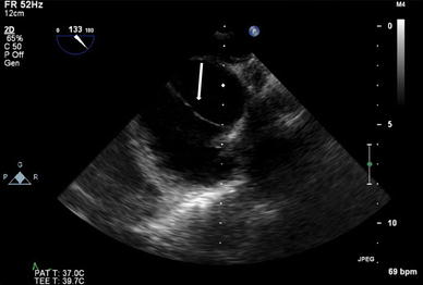 Cor Triatiratum Dexter: A Rare Cause of Isolated Right Atrial ...