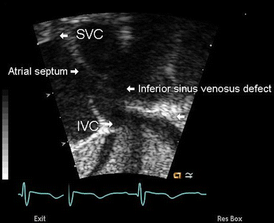 Inferior Sinus Venosus Defects: Anatomic Features and Echocardiographic ...