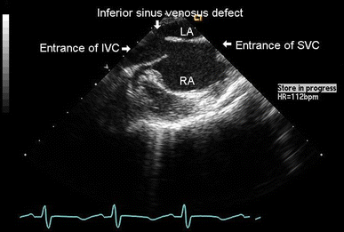 Inferior Sinus Venosus Defects: Anatomic Features and Echocardiographic ...