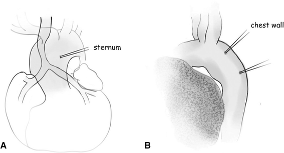 Outcomes of Aortopexy for Patients With Congenital Heart Disease ...