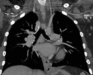 Two Cases of Warfarin-Induced Tracheobronchial Calcification After ...