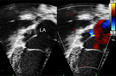 Coronary Sinus Defect Following Transcatheter Closure of ASD Using ...