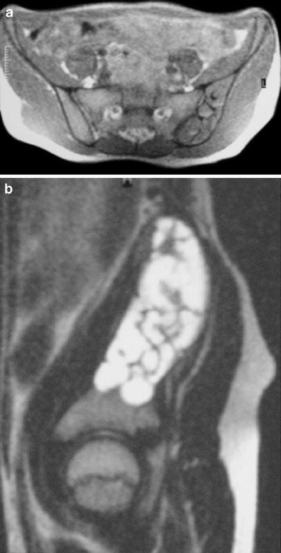 Intraosseous haemangioma of the ilium | SpringerLink