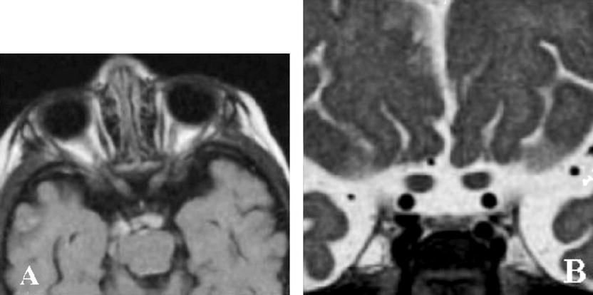Krabbe disease: unusual MRI findings | SpringerLink