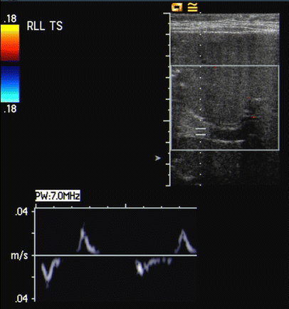 Radiological staging in children with hepatoblastoma | SpringerLink