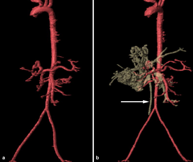 Radiological staging in children with hepatoblastoma | SpringerLink