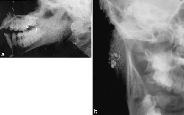 Lesions of the accessory parotid gland in children | SpringerLink