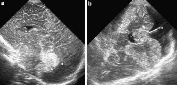 Mastoid fontanelle approach for sonographic imaging of the neonatal ...