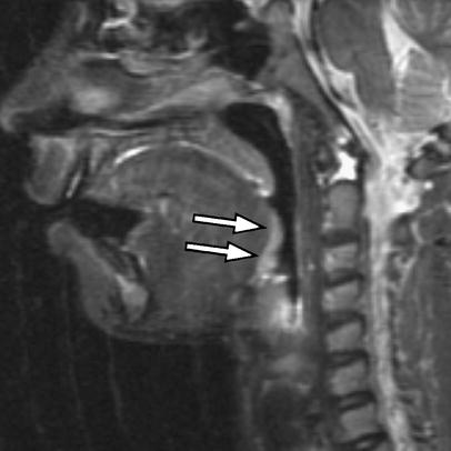 Comparison of lingual tonsil size as depicted on MR imaging between ...