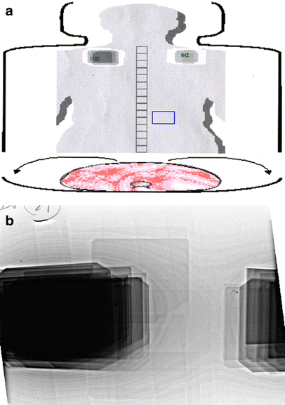 Methods for measuring fluoroscopic skin dose | SpringerLink