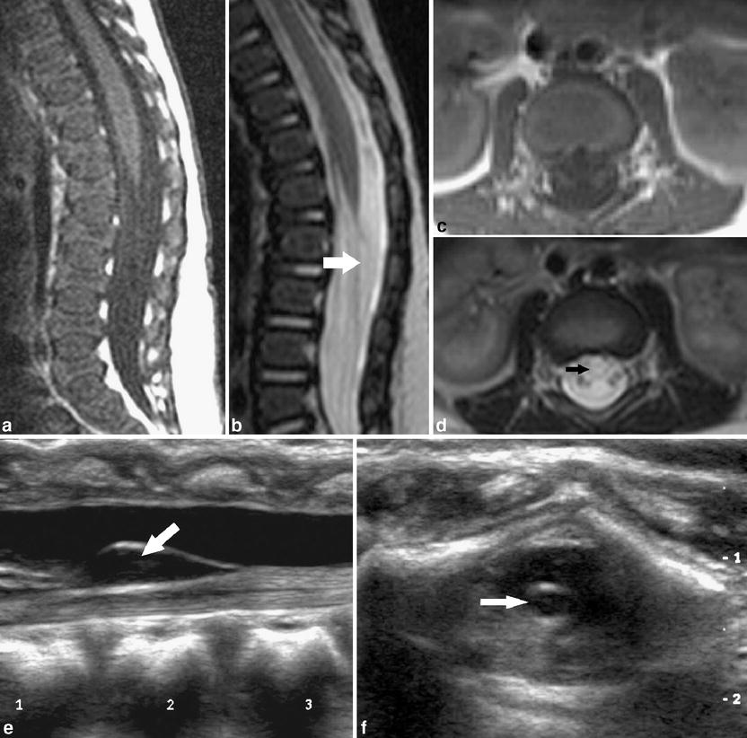 Isolated filar cyst on lumbar spine sonography in infants: a case ...