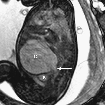 Meconium pseudocyst secondary to ileal atresia complicated by volvulus ...