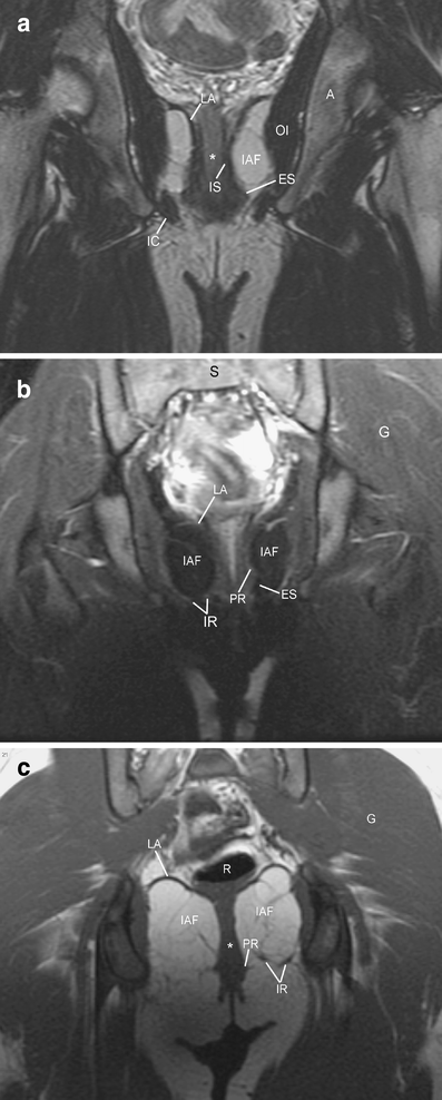 Pelvic MRI in children with Crohn disease and suspected perianal ...