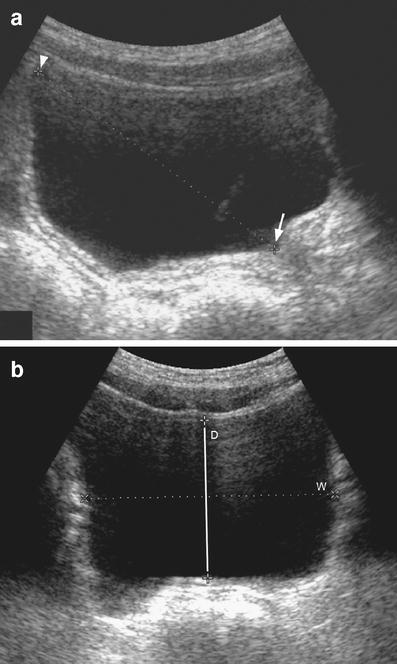Nomograms of total renal volume, urinary bladder volume and bladder ...