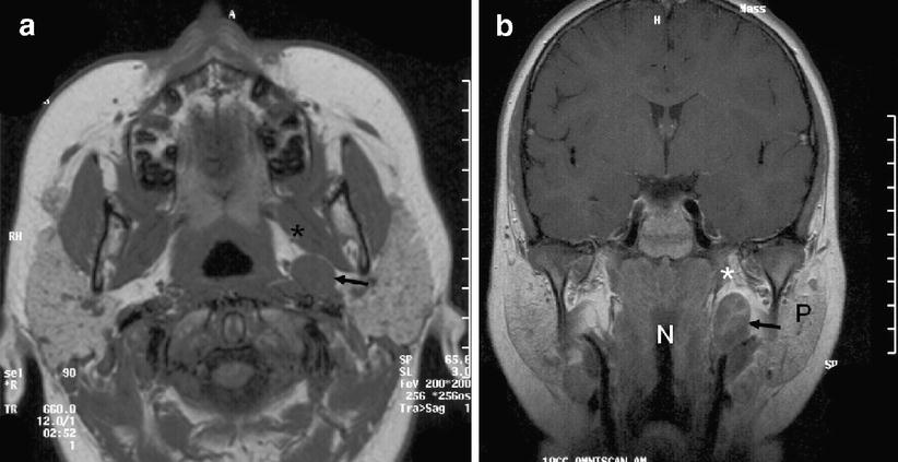 Parapharyngeal space lymphadenopathy | SpringerLink