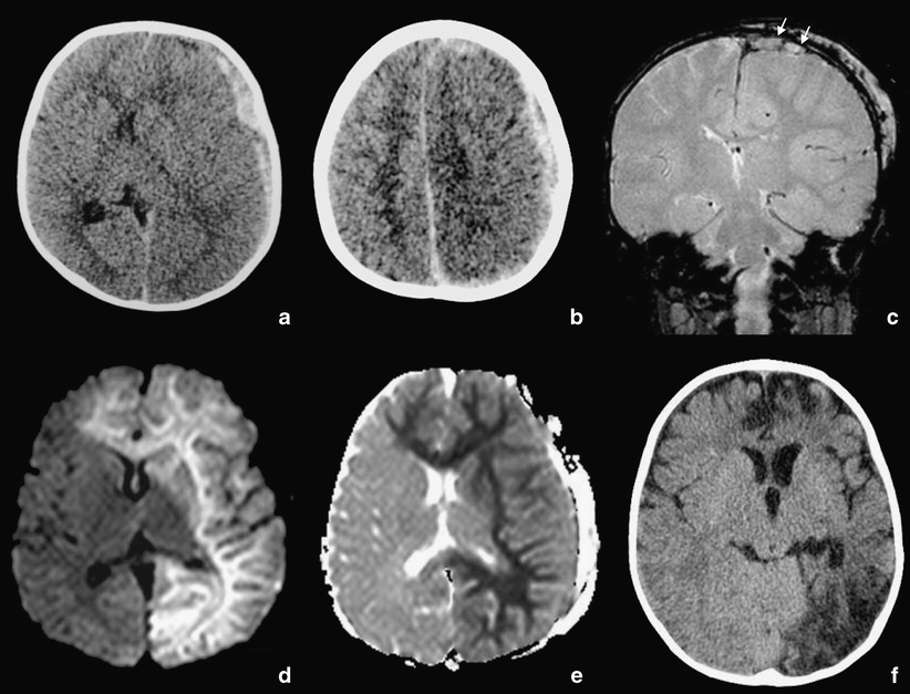 Unilateral hypoxic-ischemic injury in young children from abusive head ...
