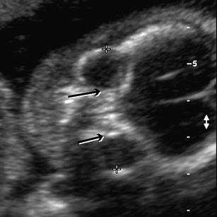 MRI of the fetal eyes: morphologic and biometric assessment for ...