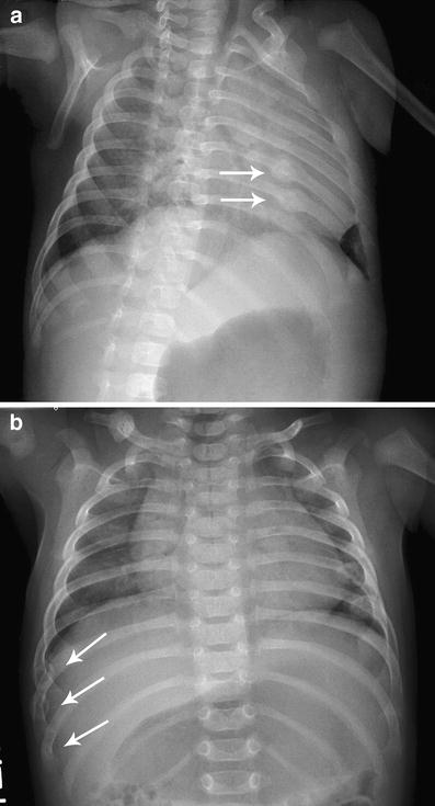 Acute rib fracture diagnosis in an infant by US: a matter of child ...