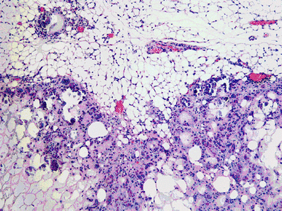 MRI and US findings of subcutaneous fat necrosis of the newborn ...