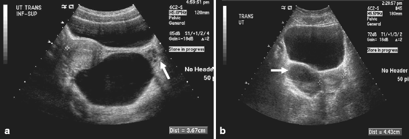 Uterine position in adnexal torsion: specificity and sensitivity of ...
