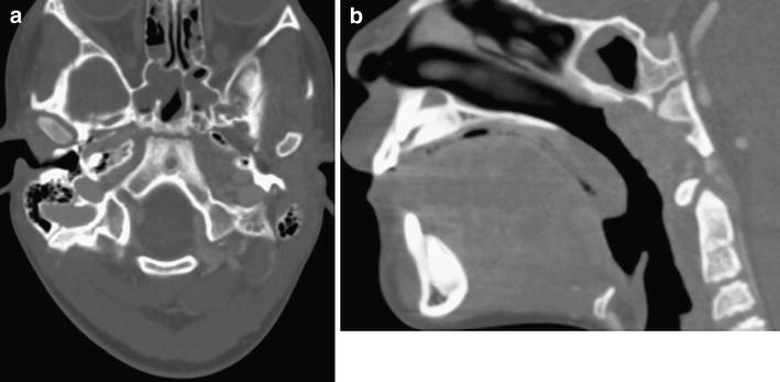 Clival osteomyelitis resulting from spread of infection through the ...