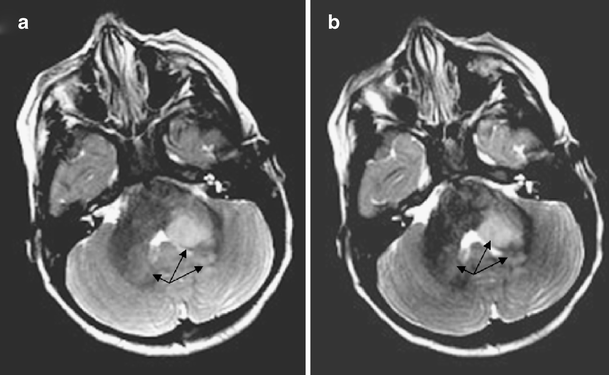 Performance of PROPELLER relative to standard FSE T2-weighted imaging ...