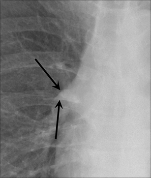 Thymic sail sign: unique to paediatric chest radiographs? | SpringerLink