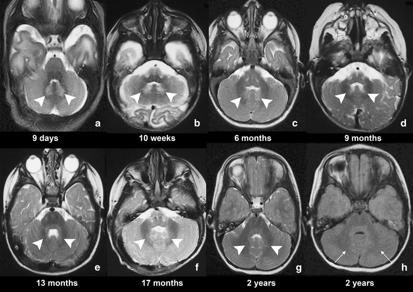 The dentate nucleus in children: normal development and patterns of ...